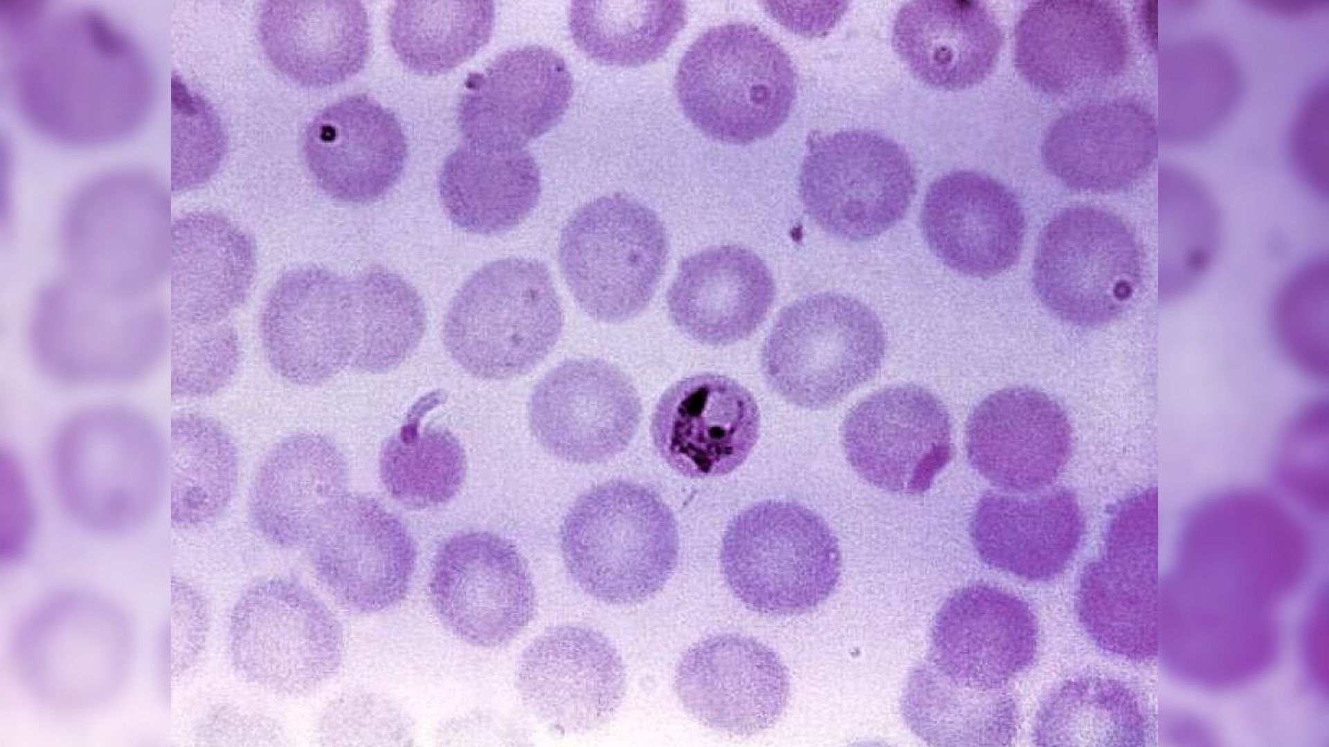Rare Zoonotic infection detected in human samples for first time in ...